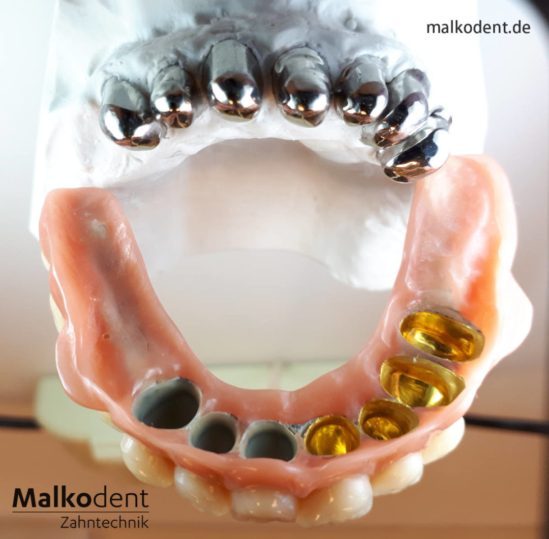 Telescopic Prosthesis System