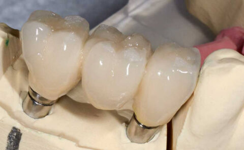 Implant-Supported Prosthetics